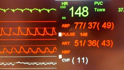 Pedi cardiology: ICU - Shape of arterial line trace