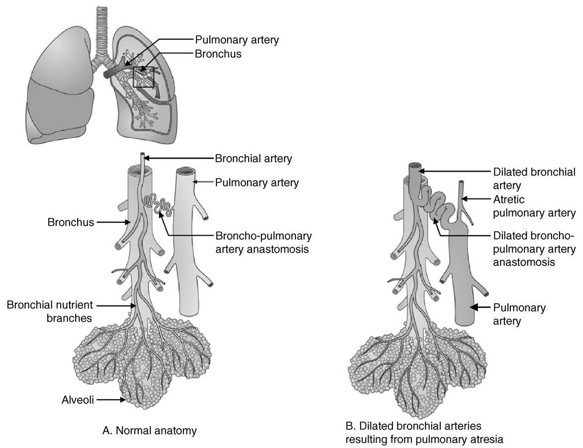 Pedi cardiology: MAPCAs - Pulmonary Atresia with VSD