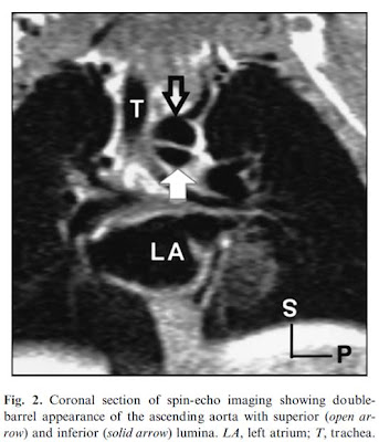 Pedi cardiology: Persistent fifth arch