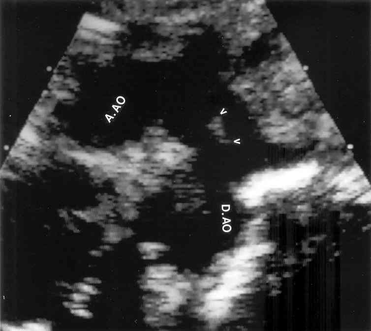 Pedi cardiology: Persistent fifth arch