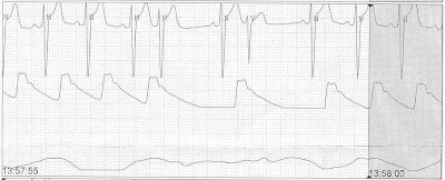 Pedi cardiology: Ventricular ectopy