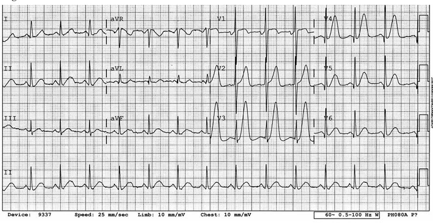 Pedi cardiology: EKG: Tall T waves