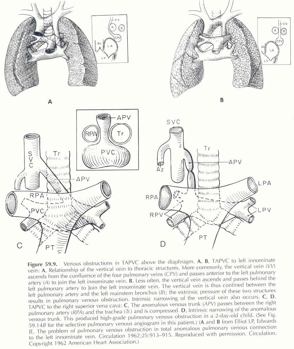 Pedi cardiology: Anatomy: TAPVR - Supracardiac type - Locations of ...