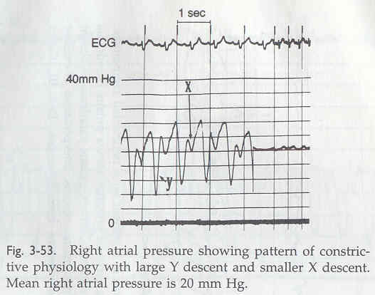 Pedi cardiology: Cath Lab: Pressure Traces in Constrictive Pericarditis