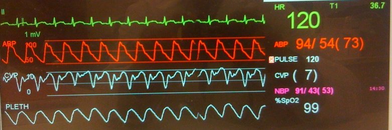 Pedi cardiology: ICU: CVP trace - Tall v wave in 2 different scenarios
