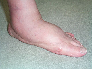 HEALTH SOLUTION Tips, Info and Guide: An Overview Of Foot Arthritis
