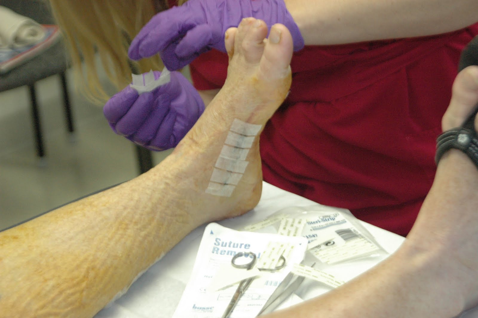 Posterior Tibial Tendon Surgery: Stitches out....new cast on