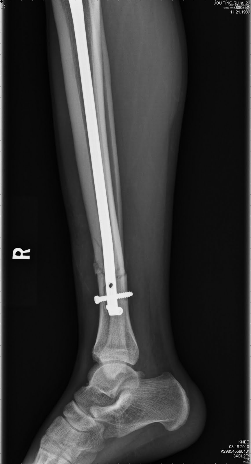 Big Bad: Neighbor tibia low shaft fracture with good callus formation