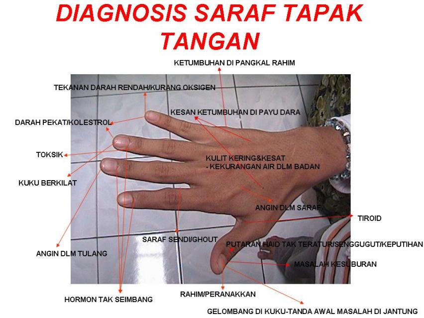 ANGGERIK'S ONLINE SHOP: DIANOGSIS SARAF TAPAK TANGAN