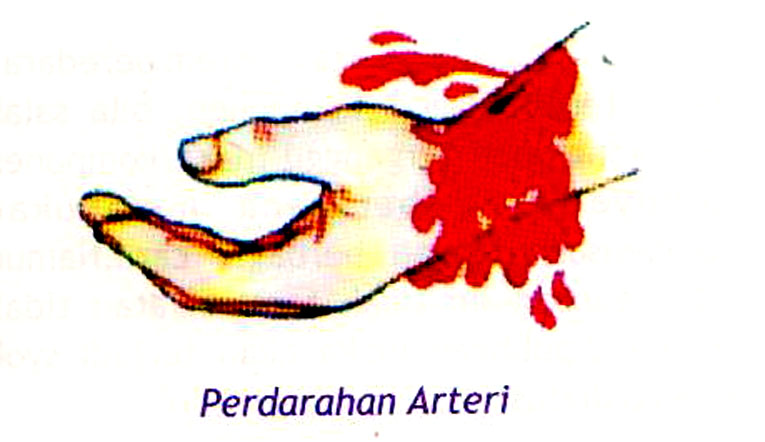 PERDARAHAN LUAR ~ Pertolongan Pertama