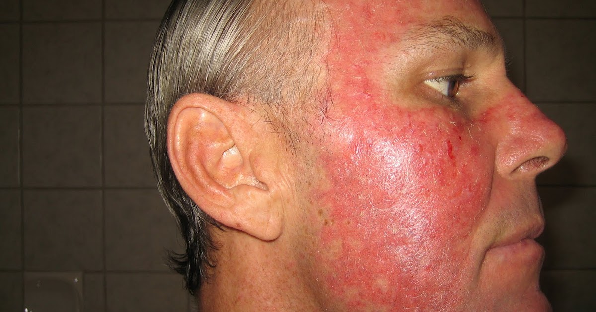 myefudixphotos: day 30 ( day 16 ) post efudix