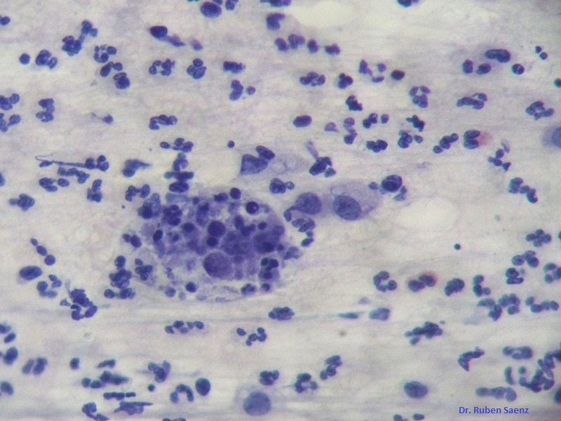 THE PERUVIAN CYTOPATHOLOGY CORNER: LESION FLOGÓTICA DE MAMA