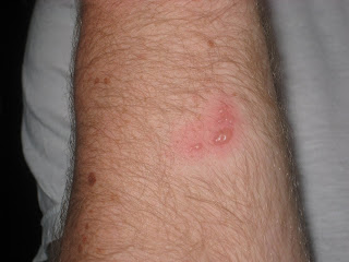 come what may, and love it: Brad's White-tailed Spider Bite!