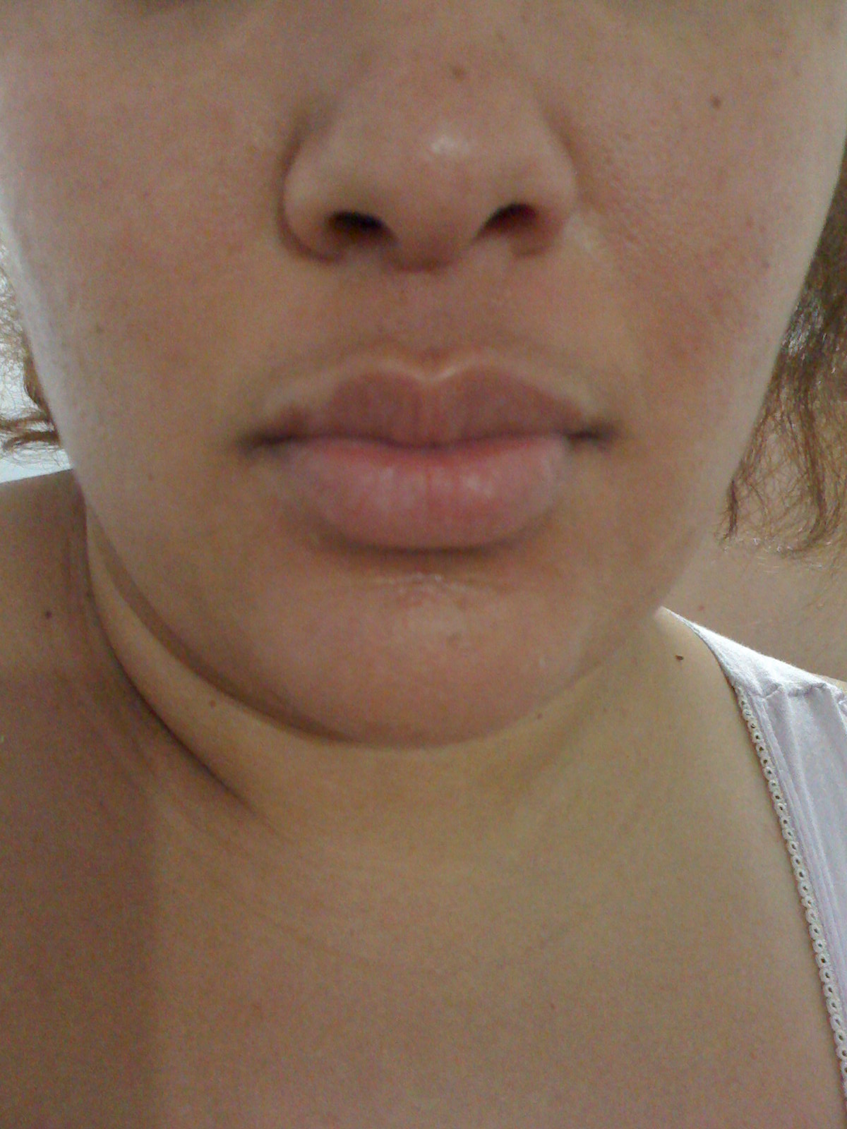 mango rash: Mango: The forbidden fruit