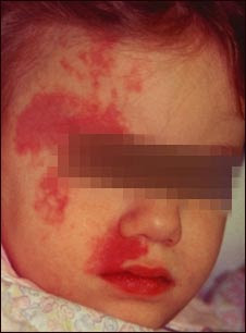 Nevus flammeus (manchas en vino de oporto)