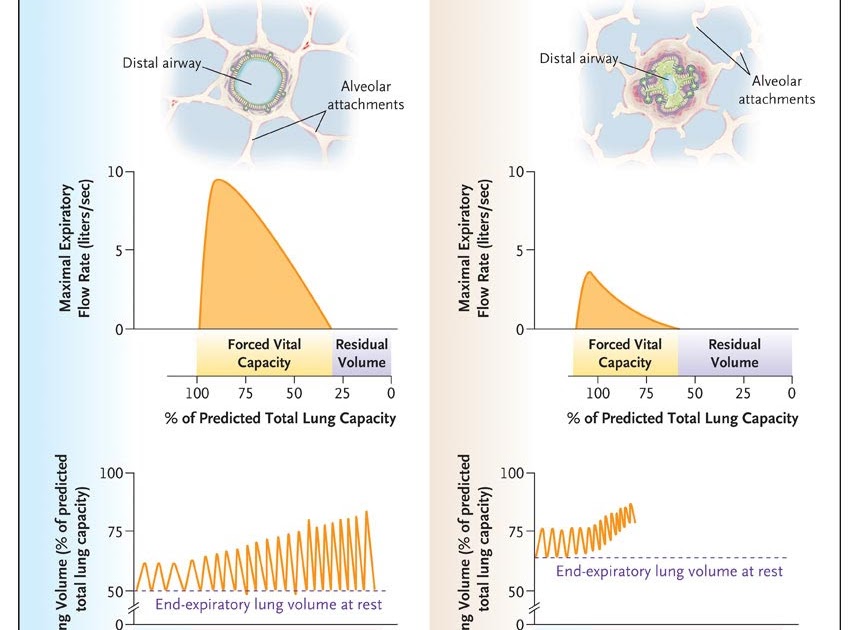 Phimaimedicine: 479.Outpatient management of severe COPD