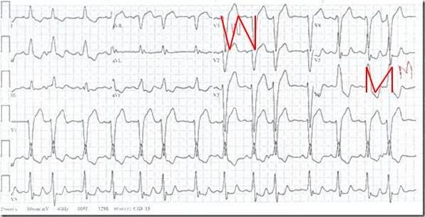 Phimaimedicine: 58. Differentiate LBBB and RBBB, easy