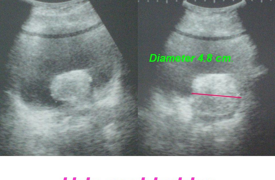 Phimaimedicine: 242. Benign prostatic hyperplasia/Ultrasound