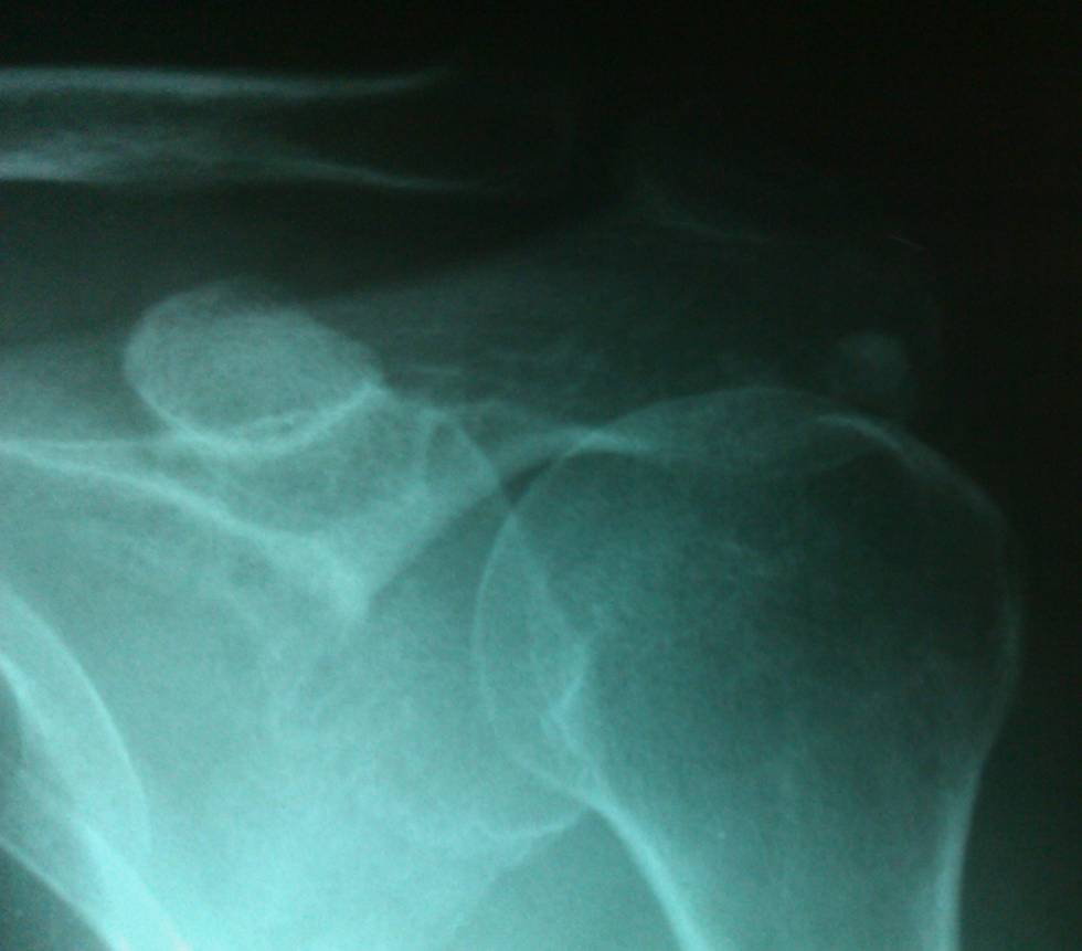 Phimaimedicine: 604. Rotator cuff calcific tendonitis