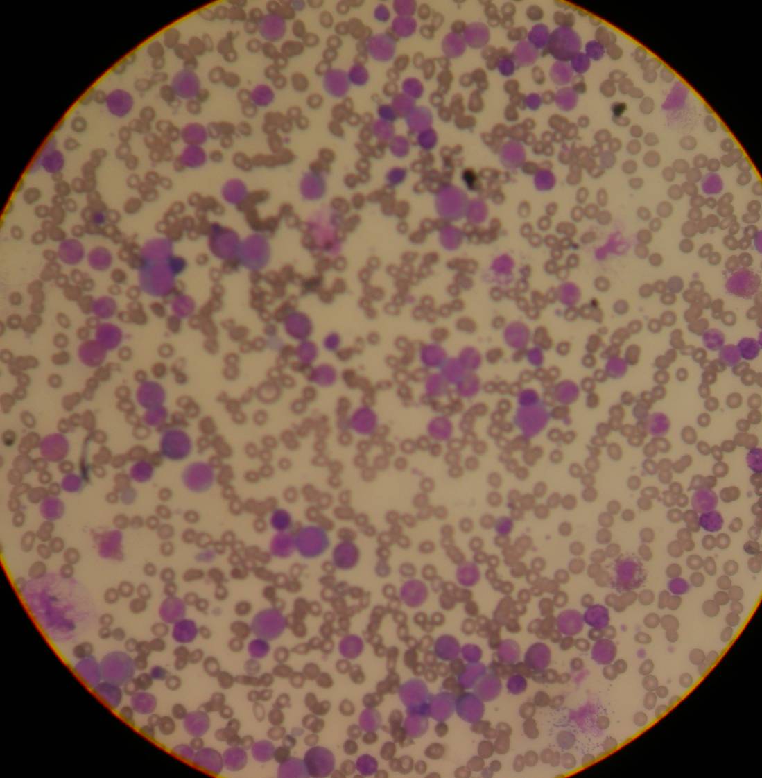 Phimaimedicine: 618. Chronic myeloid leukemia (CML)