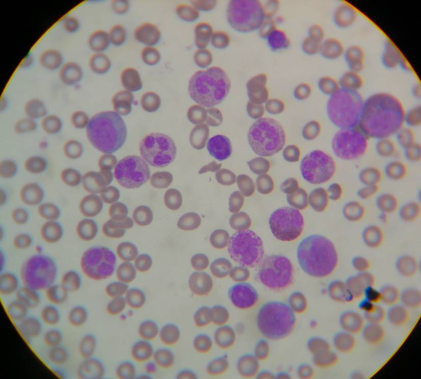 Phimaimedicine: 618. Chronic myeloid leukemia (CML)