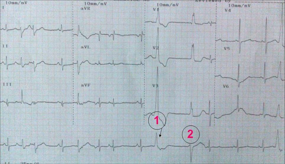 Phimaimedicine: 719. Multifocal premature ventricular complex