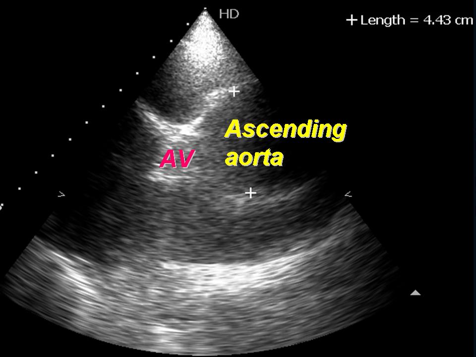 Phimaimedicine: 791. Post-stenotic aortic dilatation in aortic stenosis