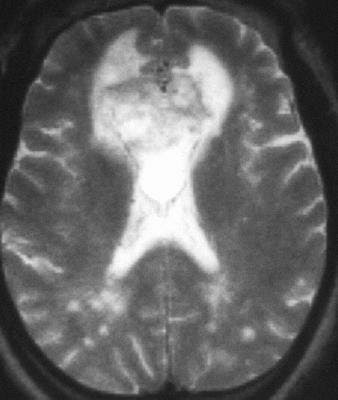 UNDERSTANDING MRI: GLIOBLASTOMA MULTIFORME