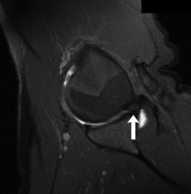 UNDERSTANDING MRI: MRI OF SHOULDER IMPINGEMENT SYNDROME