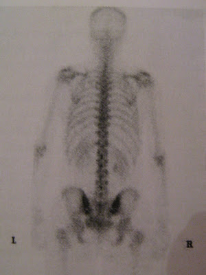 Nuclear Medicine - Another Way Of Learning: BONE SCANS