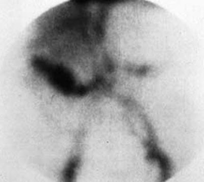 Nuclear Medicine - Another Way Of Learning: LABELLED RED BLOOD CELL SCAN