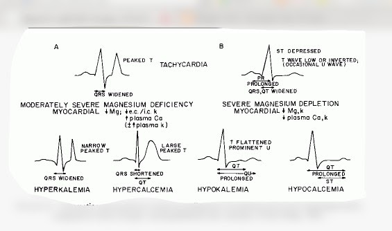 ECG - An Easier Way Of Learning: Hypercalcaemia