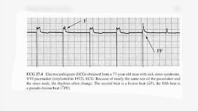 ECG - An Easier Way Of Learning: PACEMAKERS
