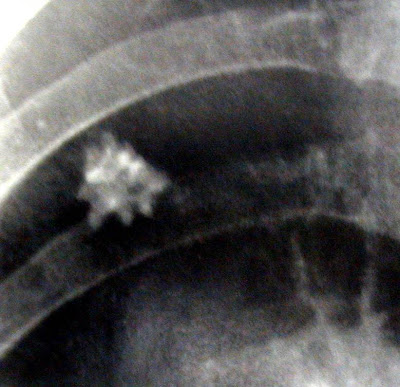atlas of medicine: POPCORN CALCIFICATION