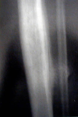 atlas of medicine: Onion skin periosteal reaction