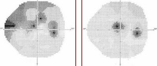 Portafolio Tecnología Médica Oftalmología: (13) Analisis de campos ...