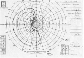 Portafolio Tecnología Médica Oftalmología: (12) Analisis de campos ...