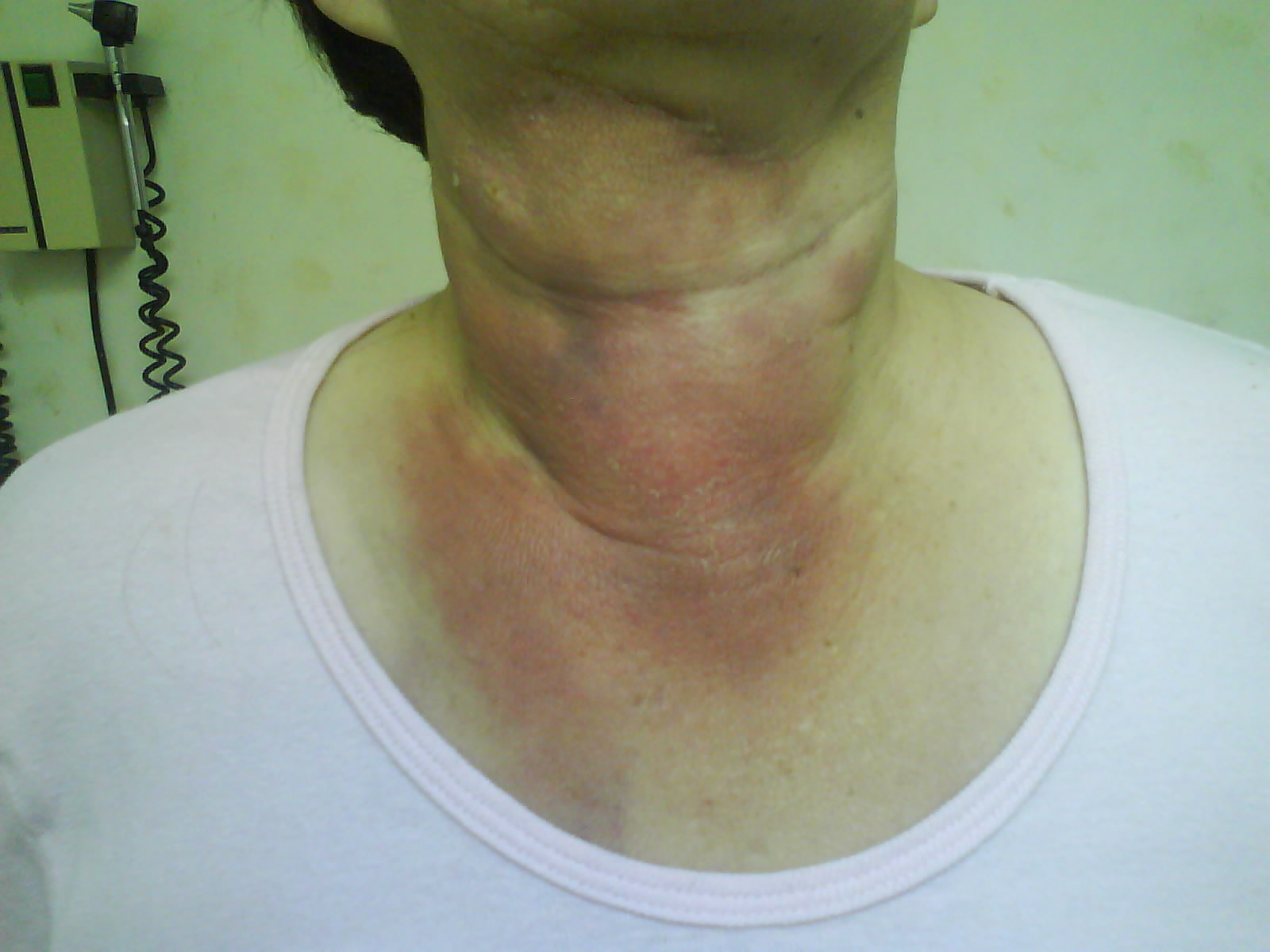 Egresados Medicina Tijuana: ABSCESO CERVICAL EN PACIENTE CON DIABETES ...