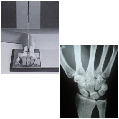 Rayos 2011: Muñeca Proyeccion PA