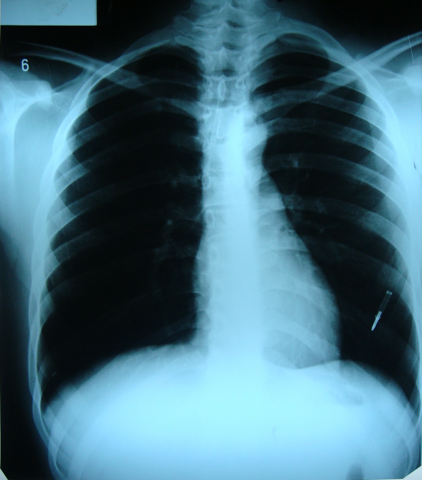 Rayos 2011: Tórax - Placas