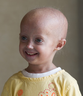 Epidemiologia y Salud Publica: PROGERIA
