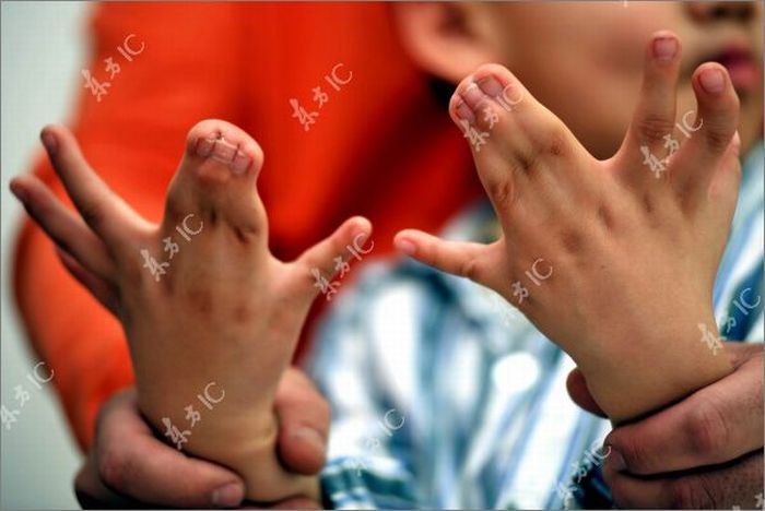My Funny: 6-Year-Old Boy Who Has 15 fingers and 16 toes | Pictures