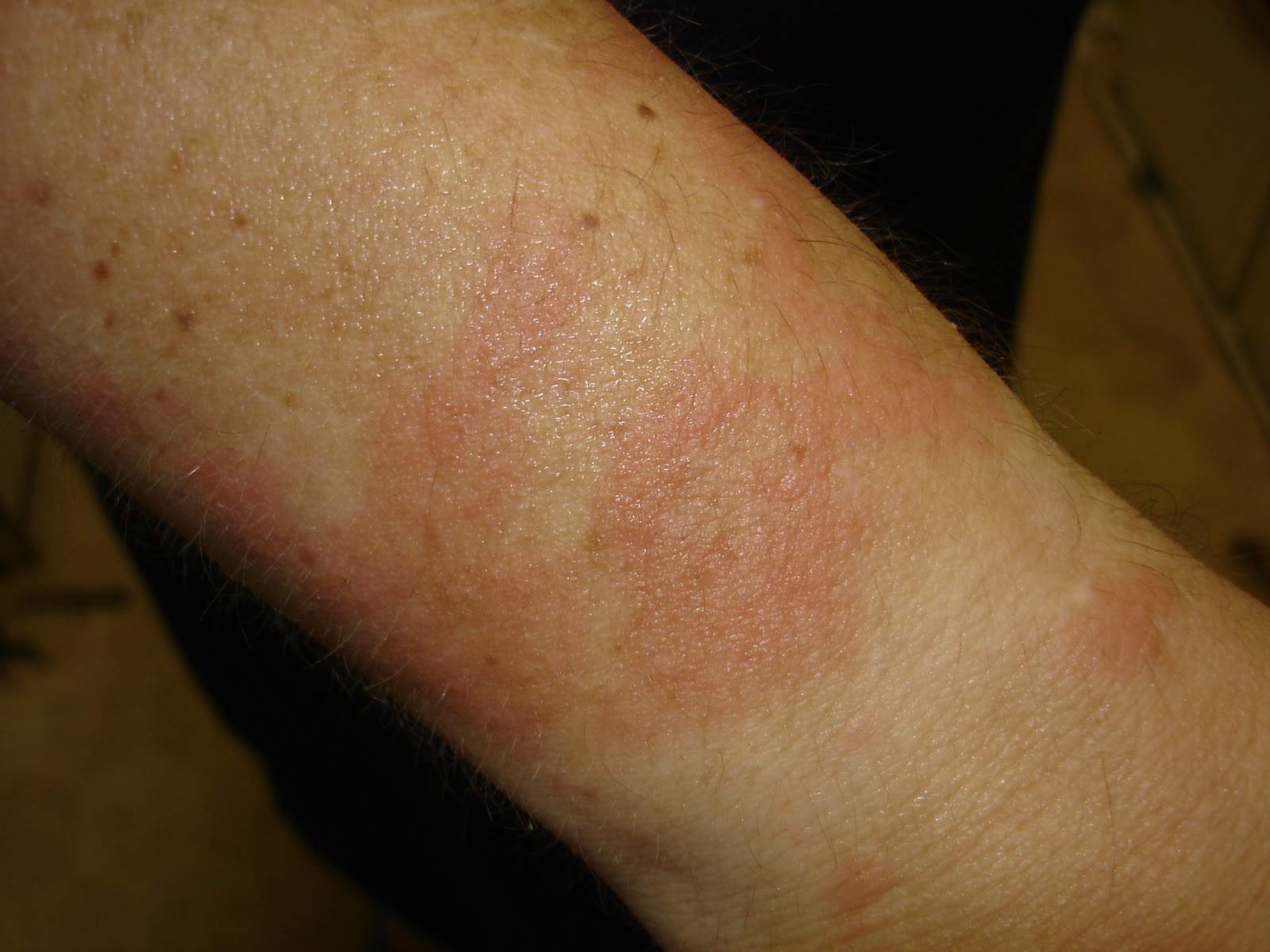 As My Fibro World Turns: Red thick scaly rash photos