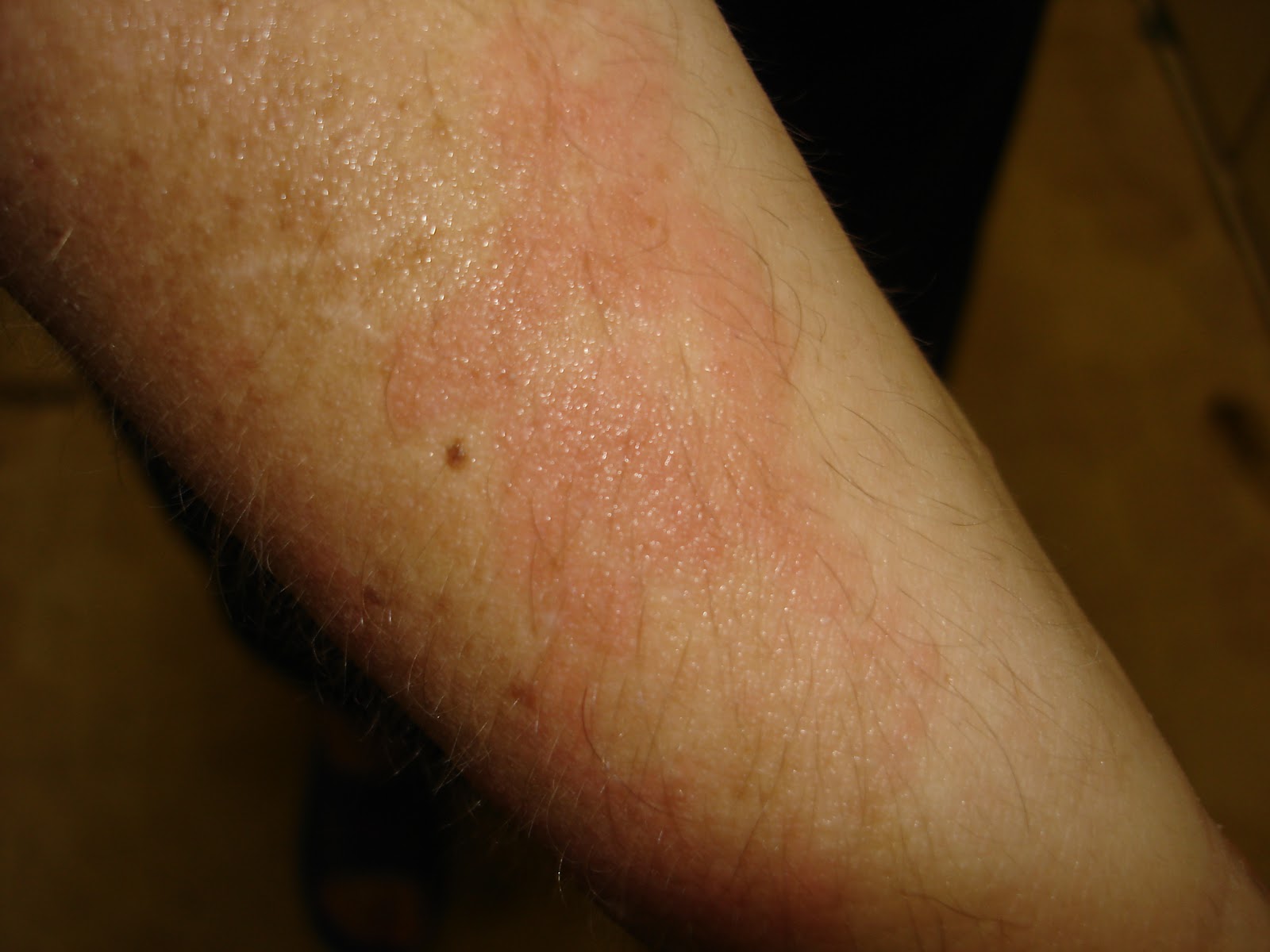 As My Fibro World Turns: Red thick scaly rash photos
