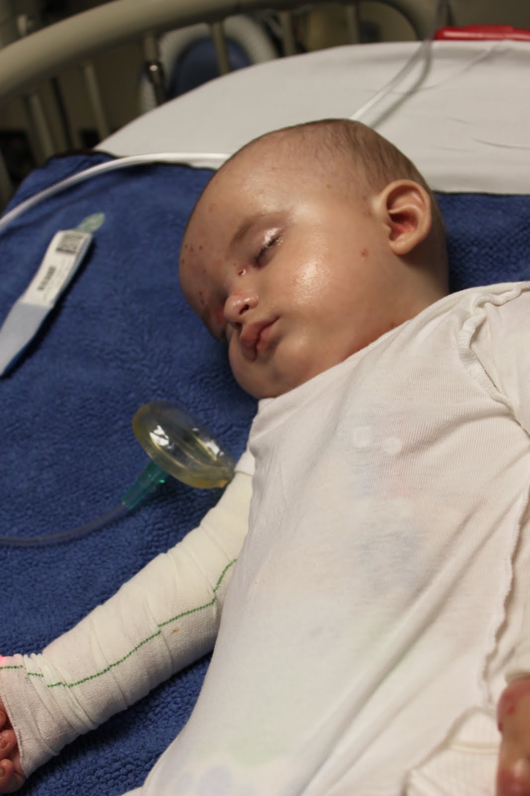 Baby Daylon: central line