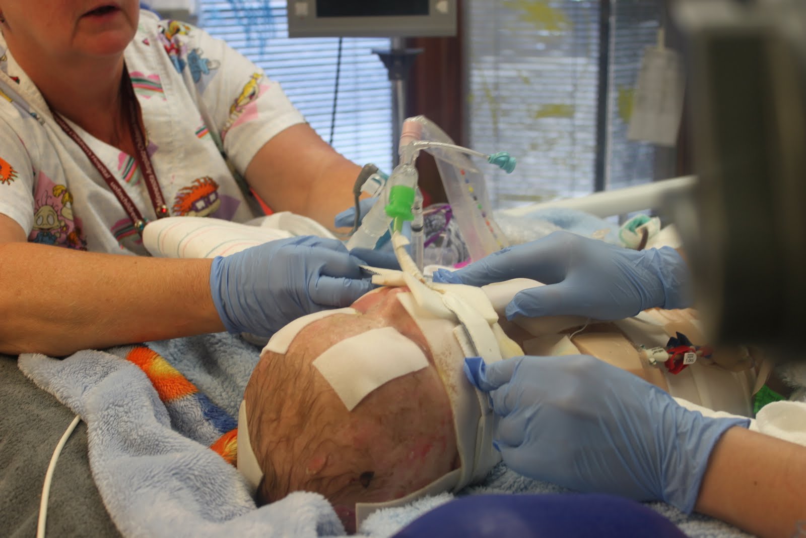 Baby Daylon: Day +46: EXTUBATION DAY!!