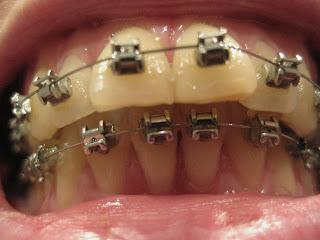 beugel: beugelbekkie