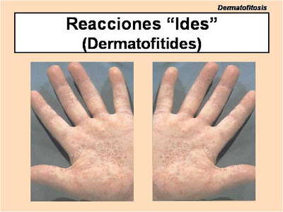 MEDICUSS: Dermatofitide