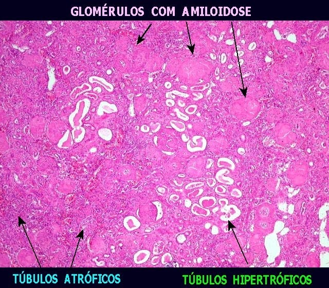AS PATOLÓGICAS: Amiloidose o que é isso!?