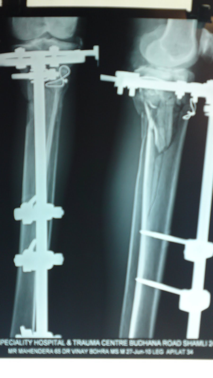 surgeries in bohra speciality hospital: compound fracture prox tibia
